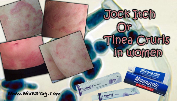 Jock Itch Tinea Cruris Skin Disorders Symptoms